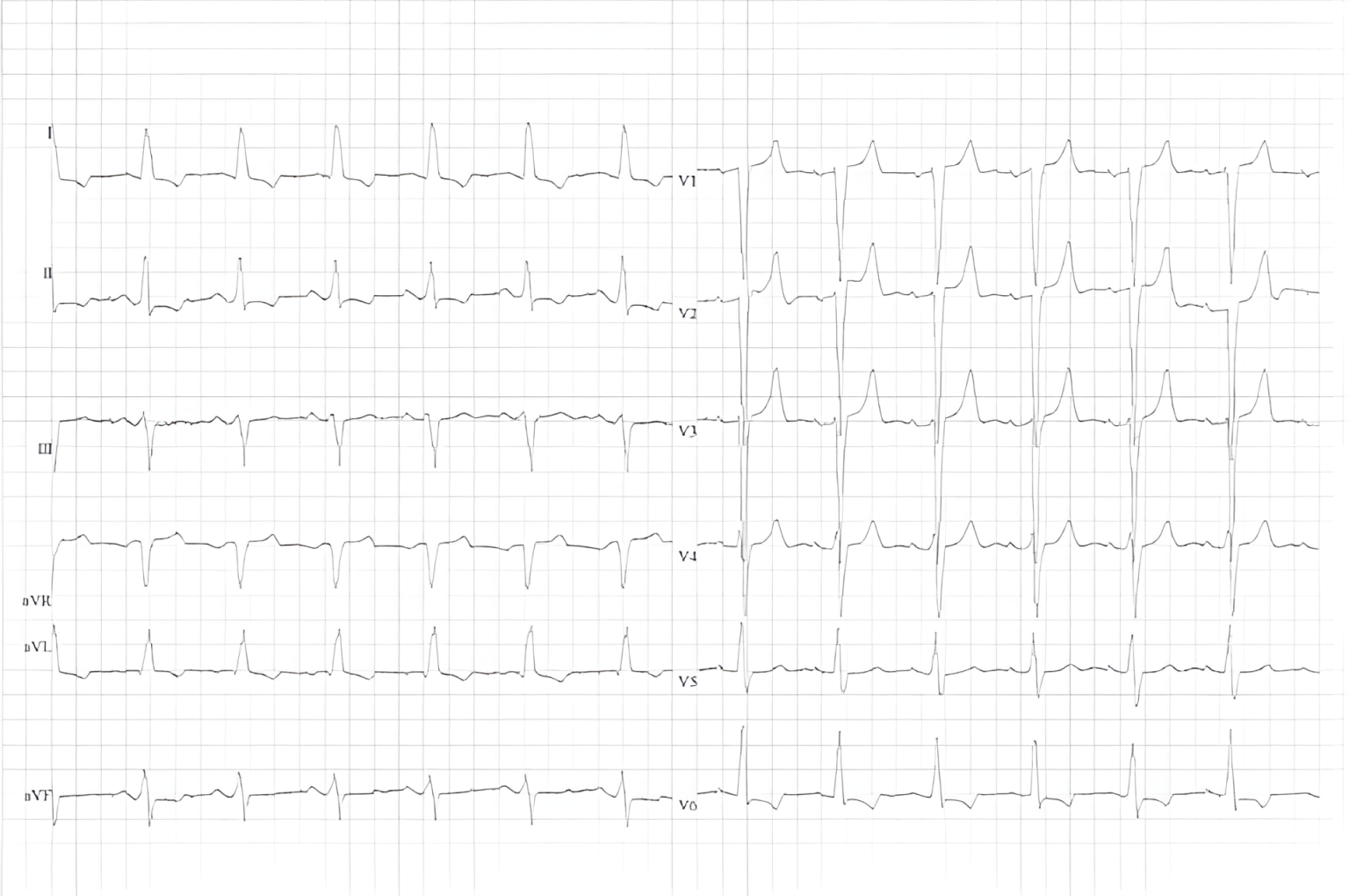 Specifieke cardiomyopathieën - Medical Pathway