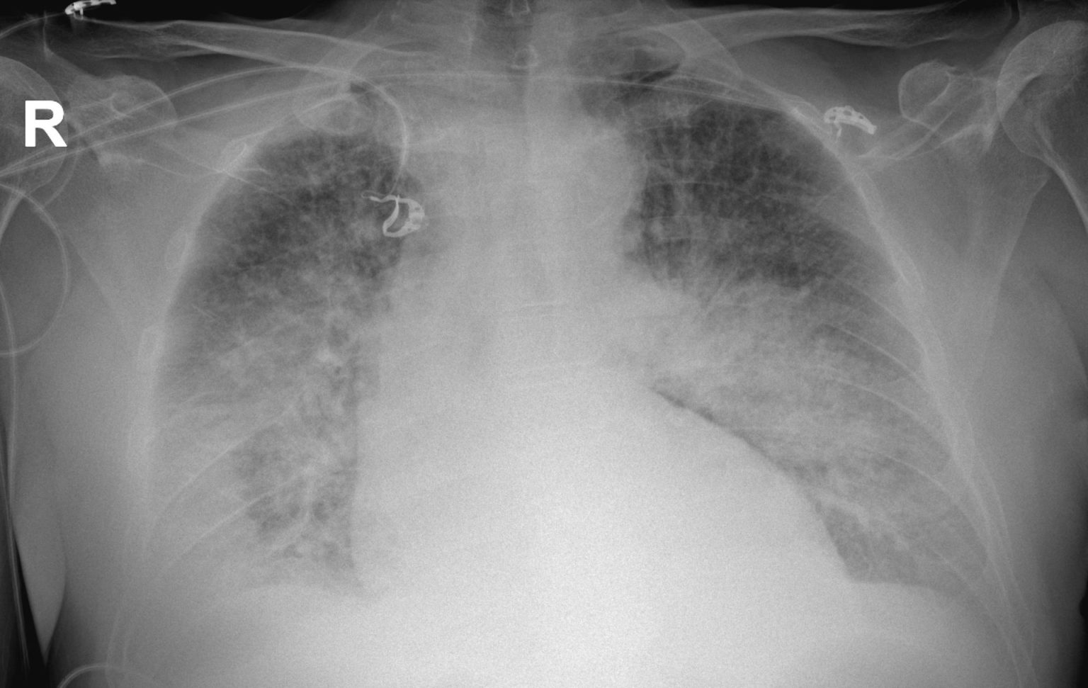 Que faire en cas de signes cliniques de décompensation cardiaque ...
